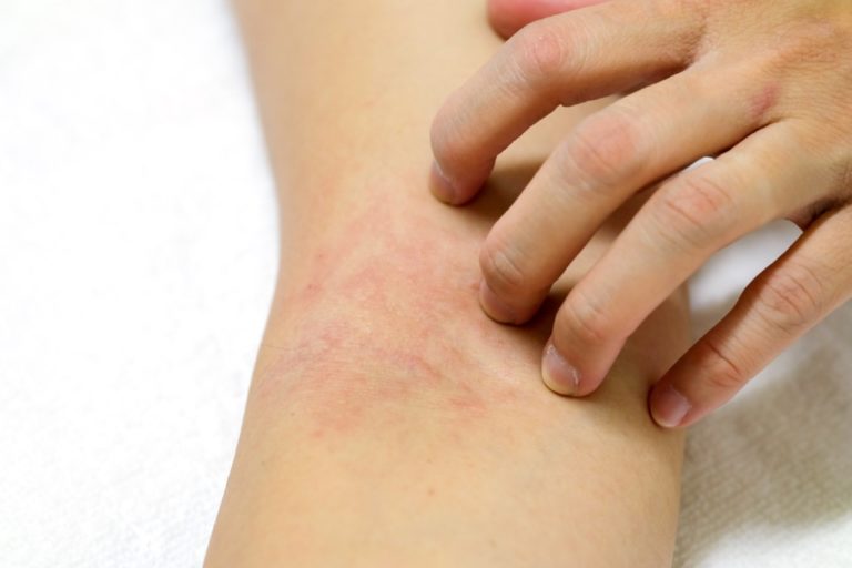 Top Five Allergic Reaction Symptoms to Insect Bites - The Pest Rangers